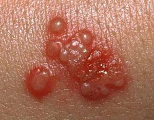 Herpes Genital Qué Es Y Cómo Puedes Evitarlo